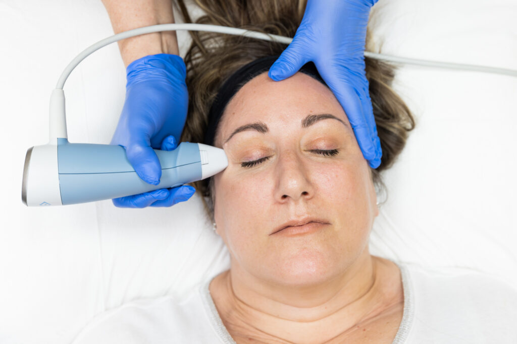 RF Microneedling in Ocala - Mid-Florida Age Management LLC